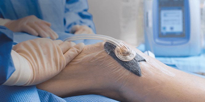 Negative-Pressure-Wound-Therapy: Medical | 3M United Kingdom